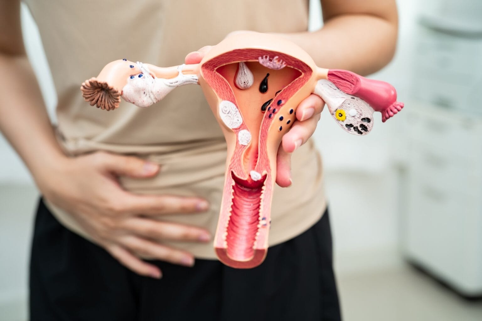 Polipi cervicali vs polipi uterini: diferențe, diagnostic și tratament ...